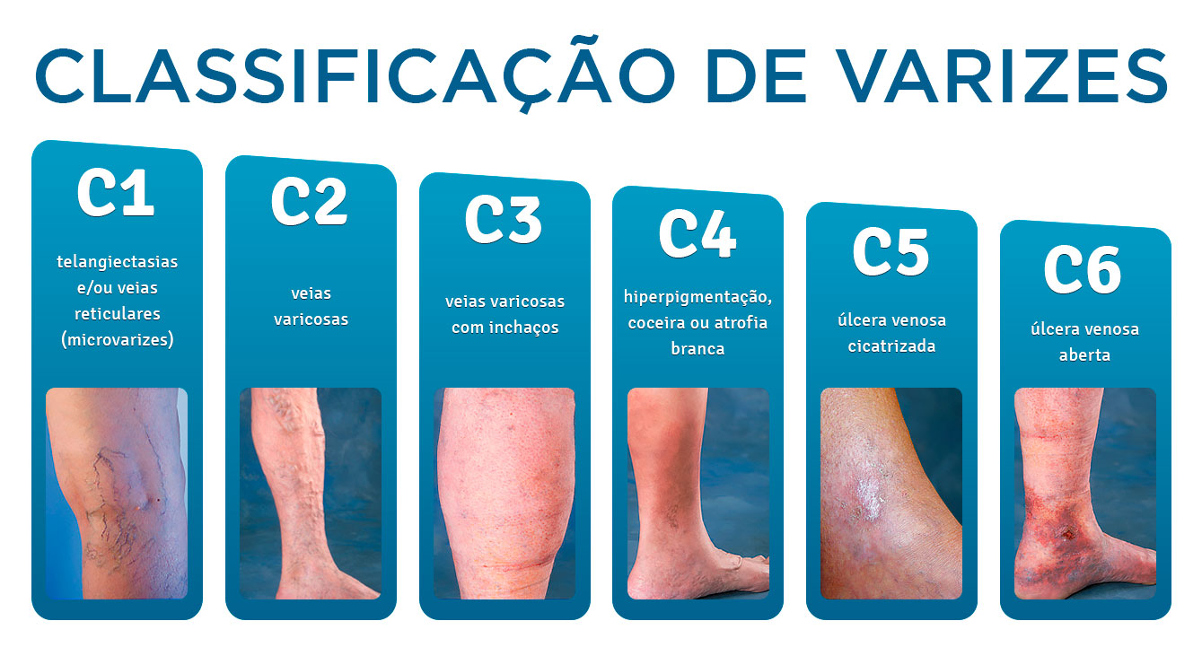 Classificação de varizes: entenda a gravidade de cada caso - Dr. Marcos ...