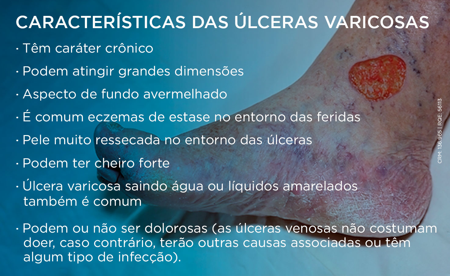 Úlcera varicosa: como identificar e tratar - Dr. Marcos Magalhães